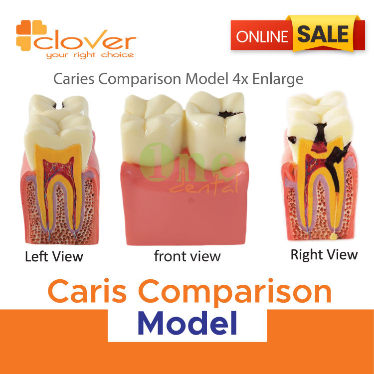 Caries Comparison Model
