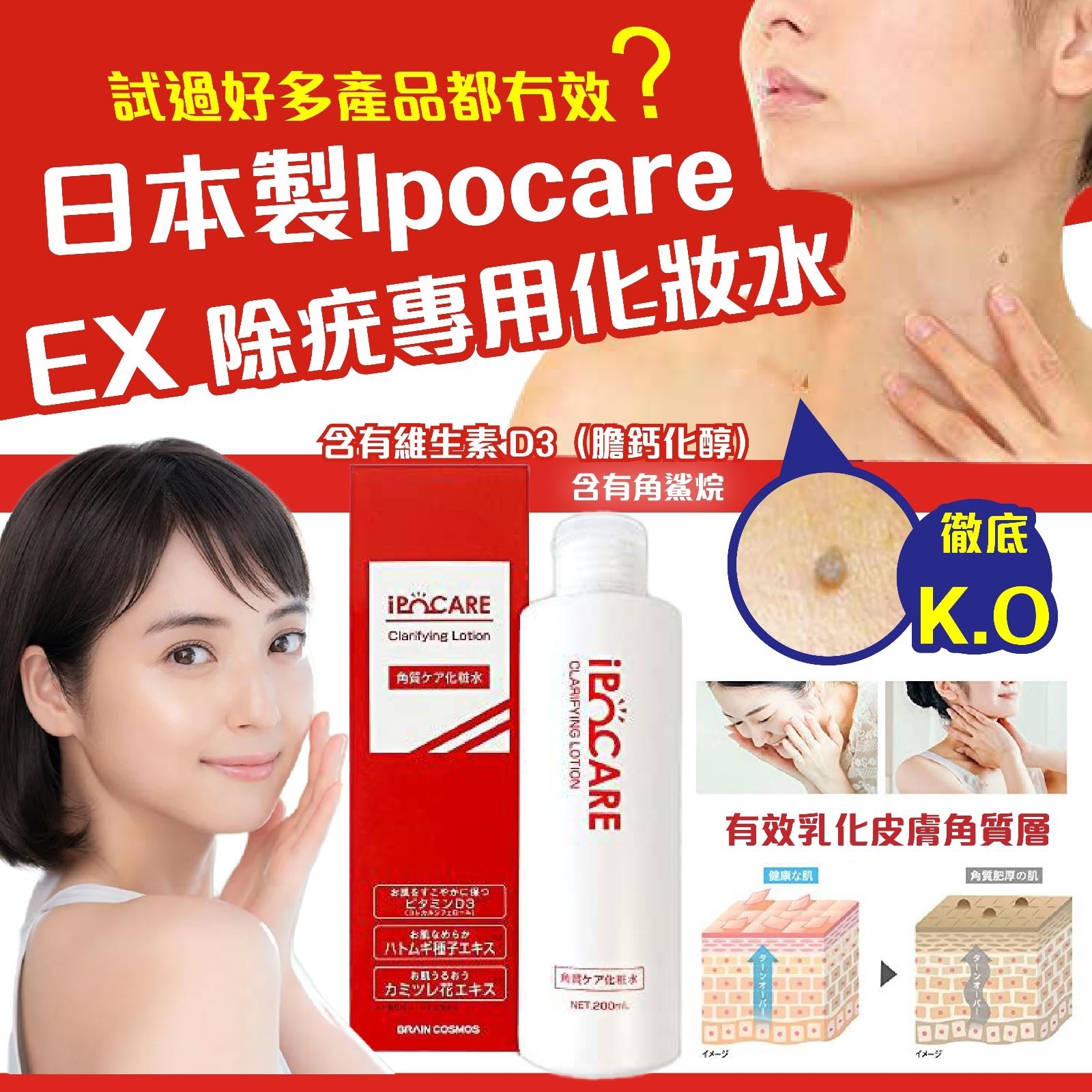 日本製 Ipocare EX 除疣專用角質化妝水 200ml