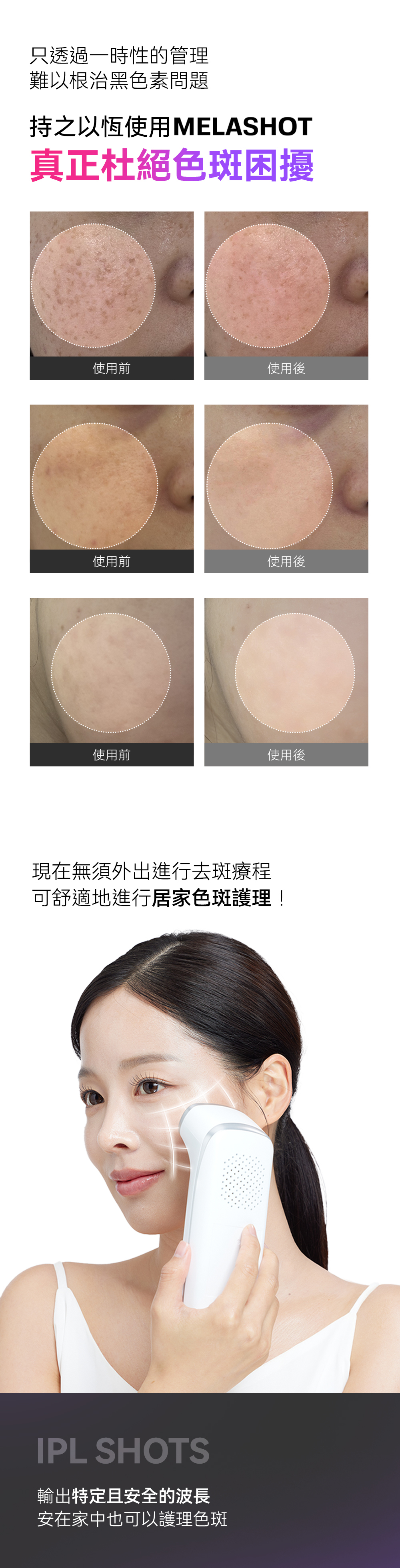 [韓國醫療協會認證] Melashot 去斑醫療美容儀