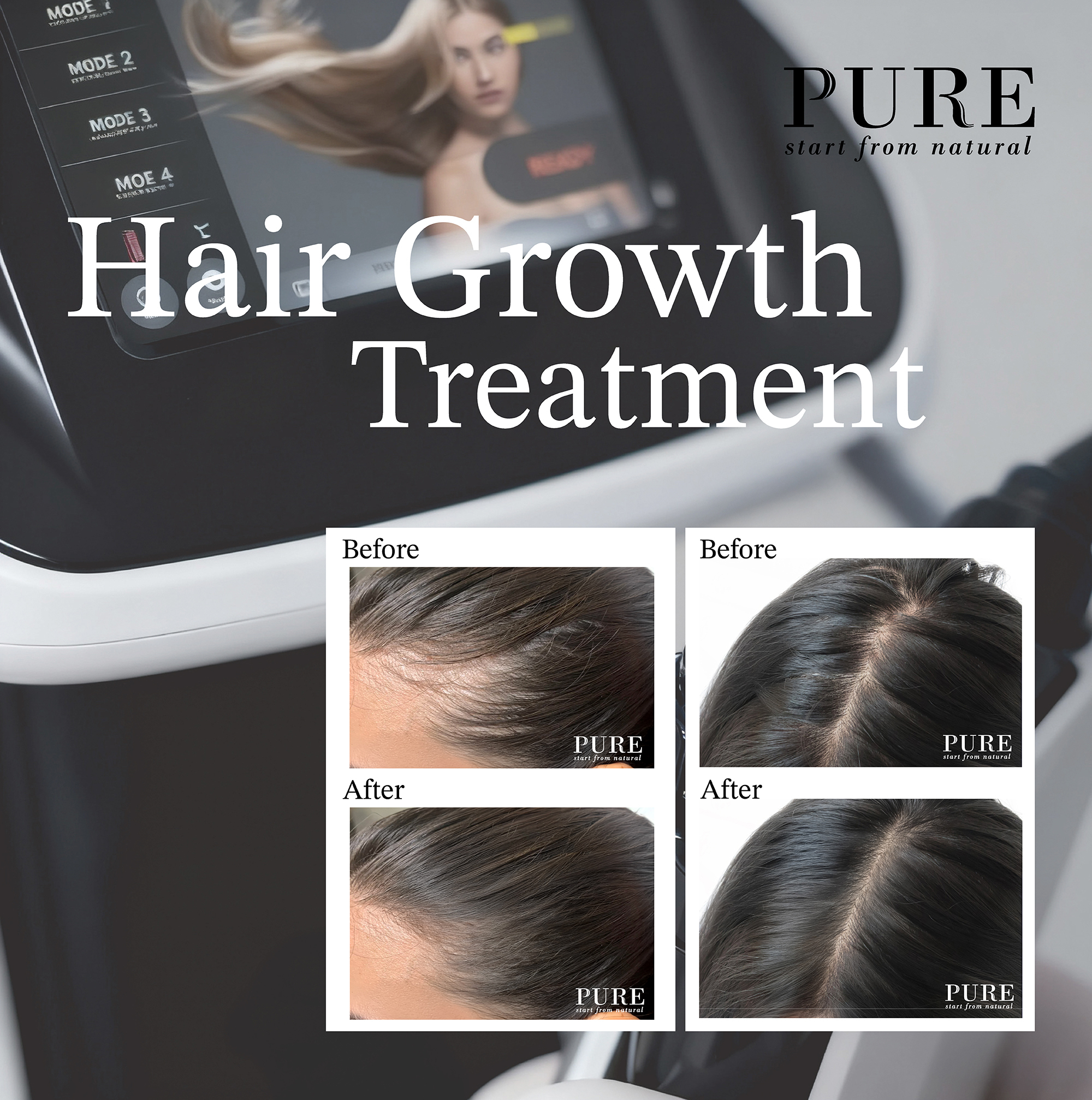 Hair Growth Treatment
